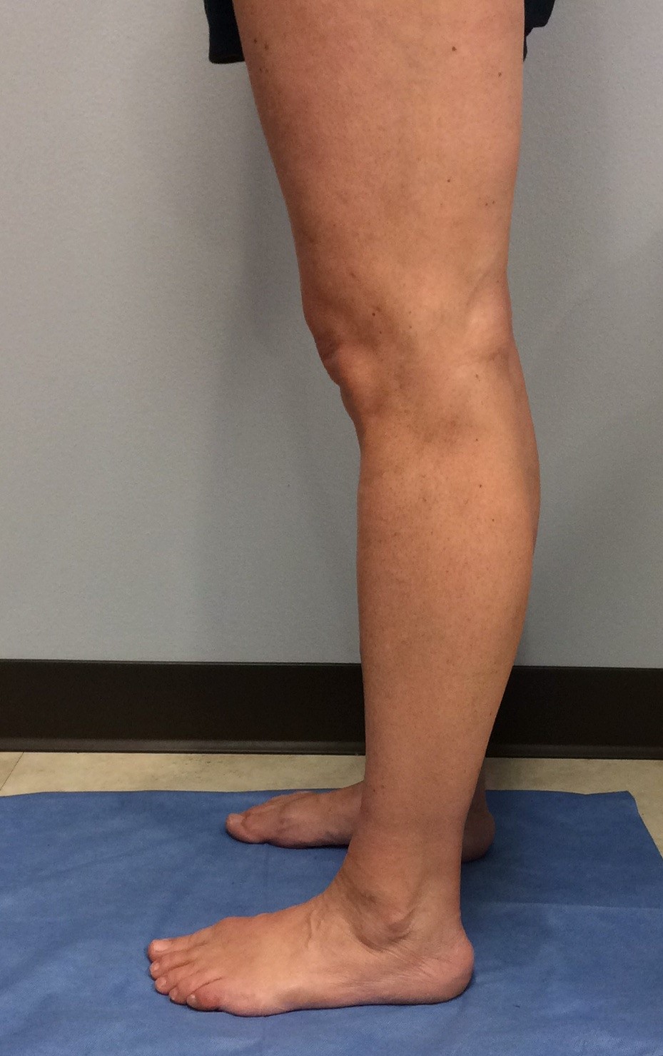 Varicose Veins Before and After Pictures & Images: Surgery & Treatment