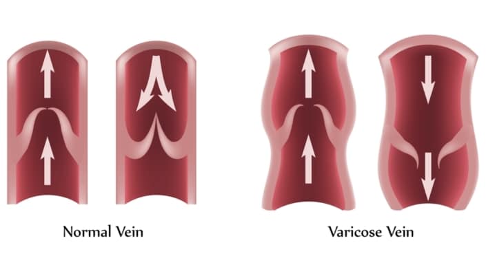 Varicose Veins Ultrasound: Vein Mapping: Mequon, Wisconsin