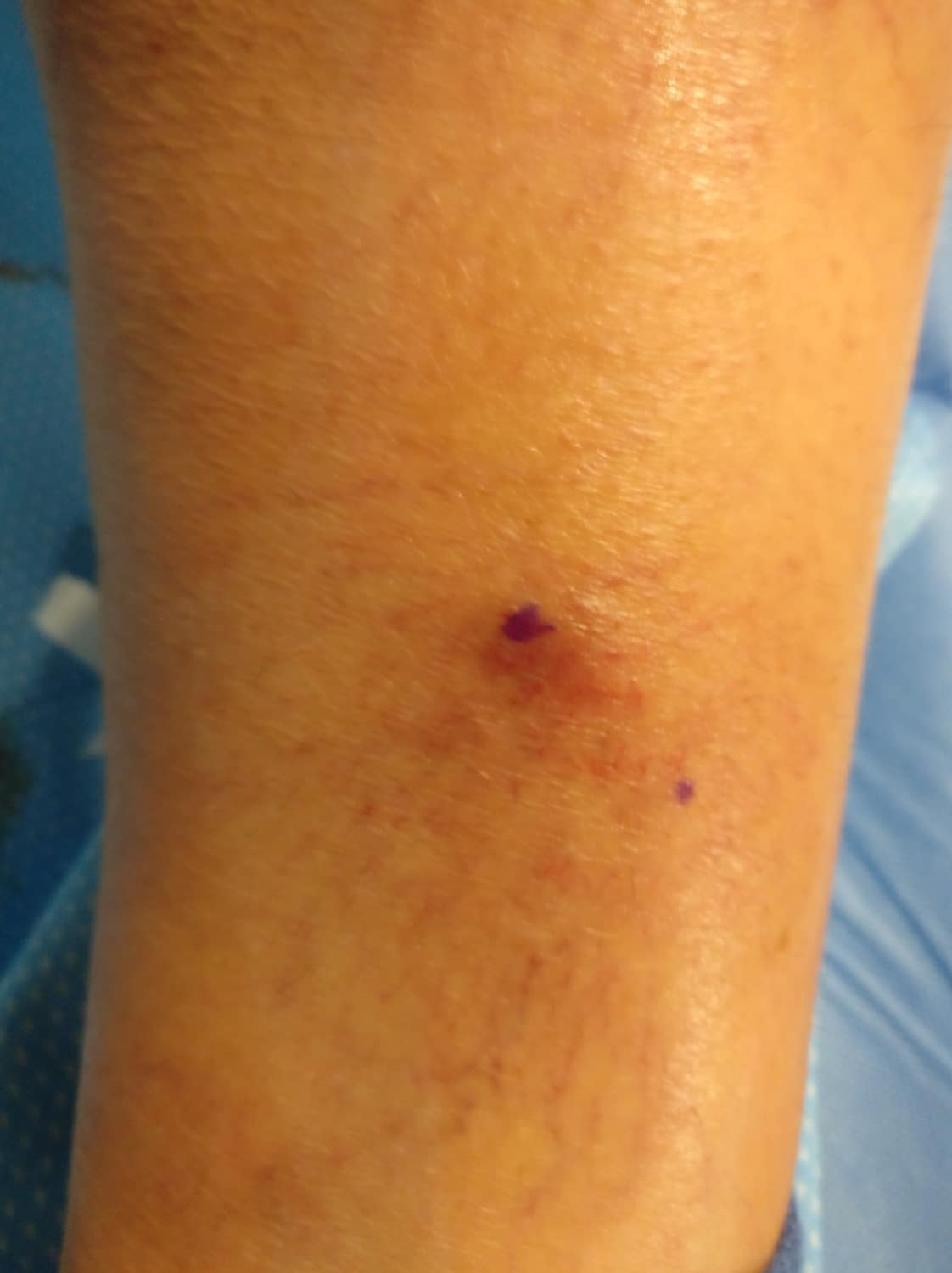 Are Varicose Veins Dangerous?