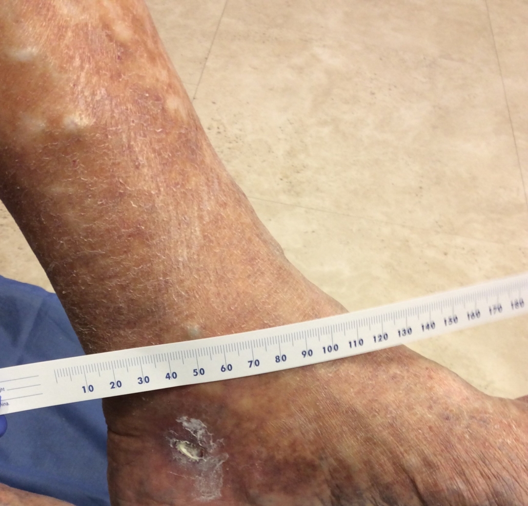 Open Sores on Legs That Won’t Heal: Itchy & Red [Picture Guide ...